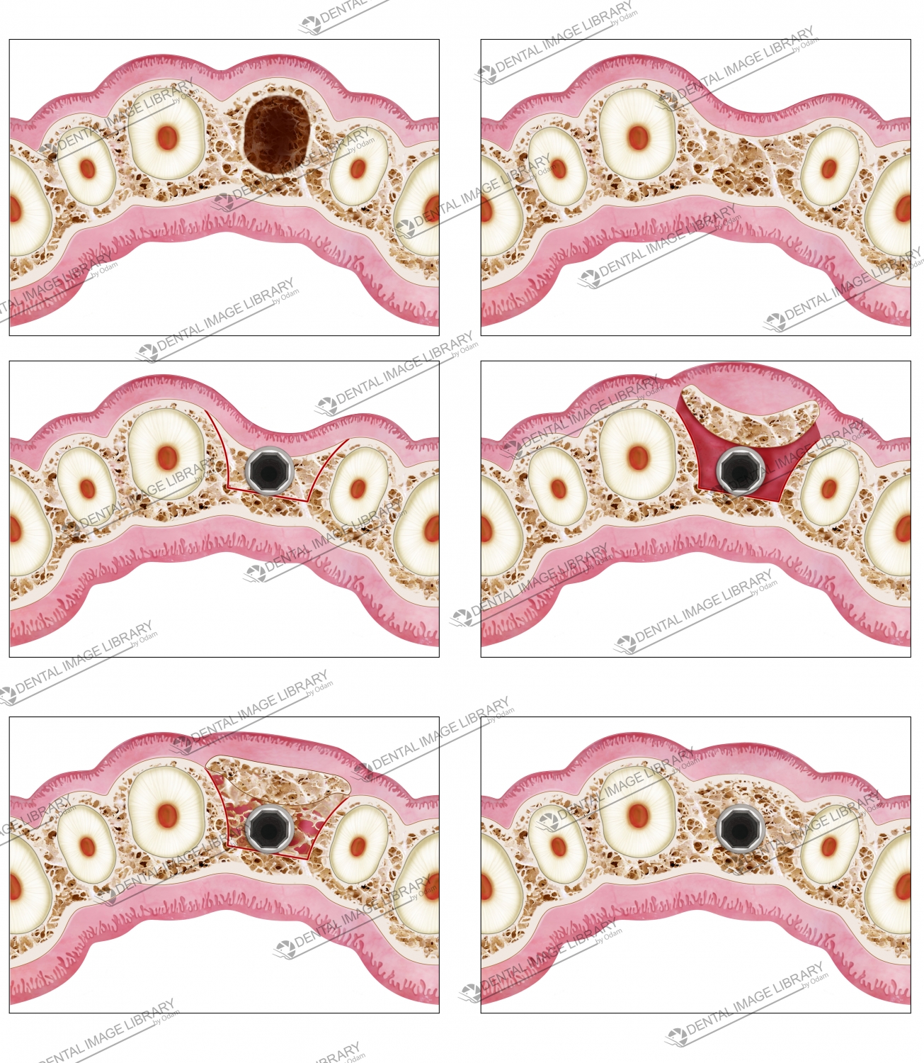 Ridge expansion technique. Collection of 6 illustrations. | Dental ...