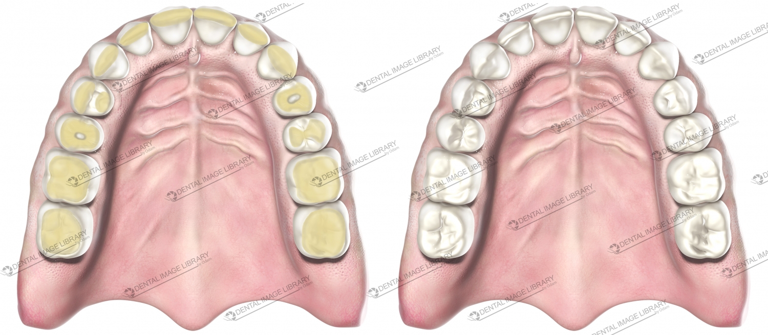Treatment of upper worn teeth. Occlusal view. Collection of two images ...