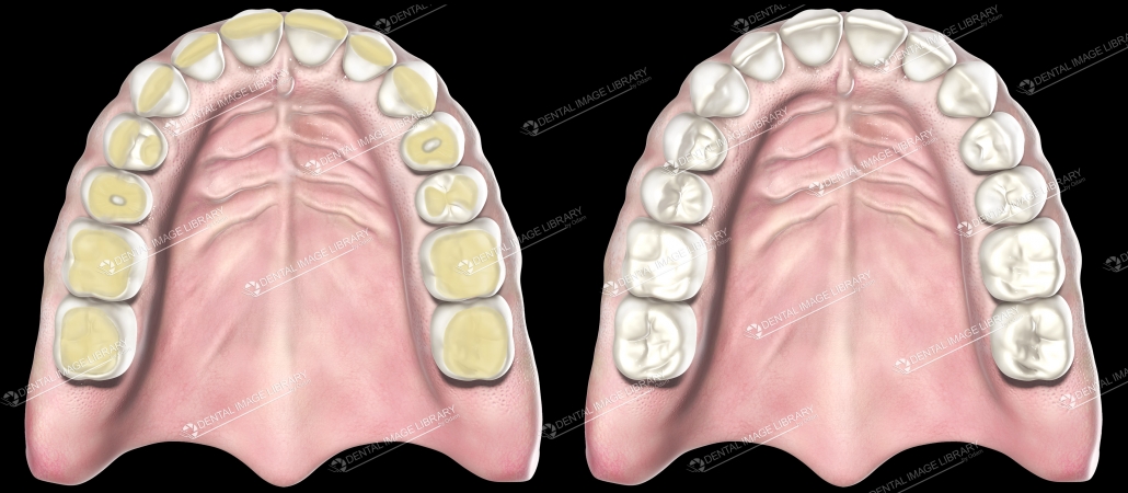 Treatment of upper worn teeth. Occlusal view. Collection of two images ...