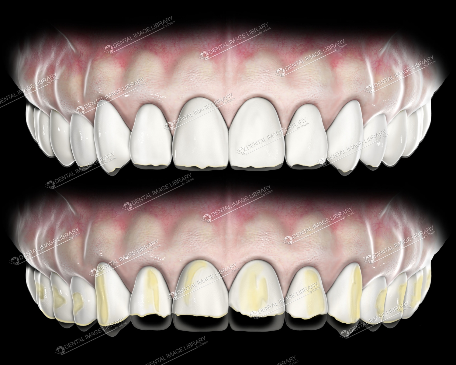 Frontal view of mild and moderate wear teeth. 21JB00023 | Dental Image ...