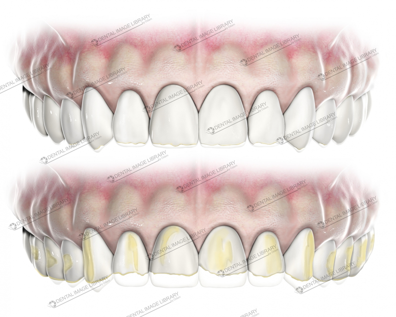 Frontal view of mild and moderate wear teeth. 21JW00022 | Dental Image ...