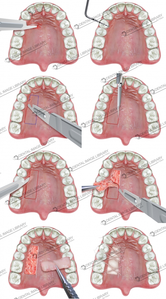 Harvesting Epithelial-Connective tissue graft from palate. Collection ...