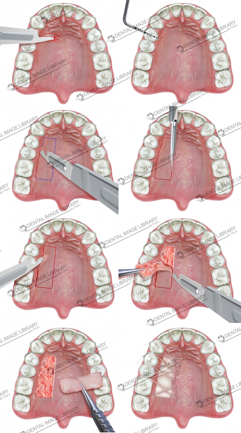 Harvesting Epithelial-Connective tissue graft from palate. Collection ...