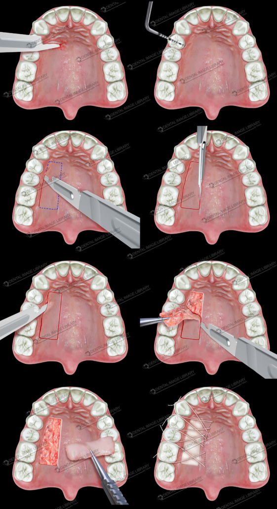 Harvesting Epithelial-Connective tissue graft from palate. Collection ...