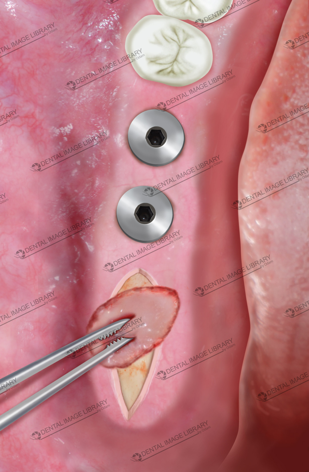 Distal wedge procedure - Implants. Collection of 4 illustrations ...