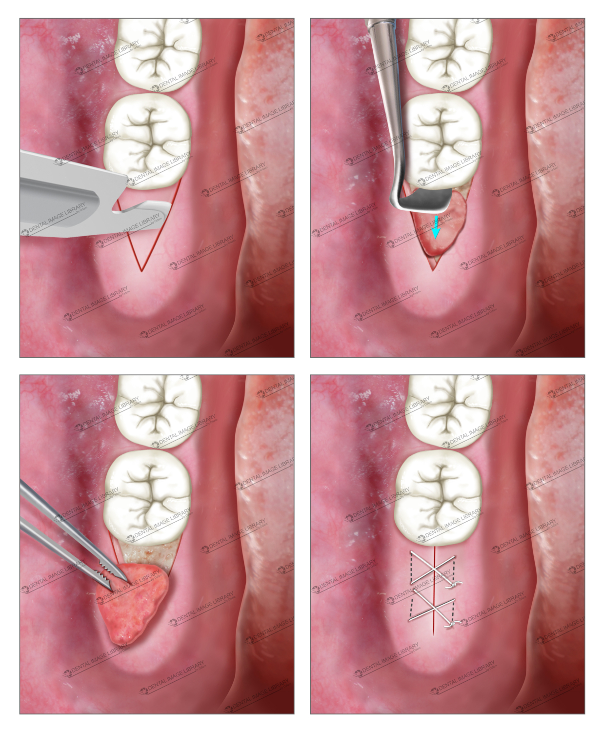 Distal wedge procedure. Collection of 4 illustrations | Dental Image ...