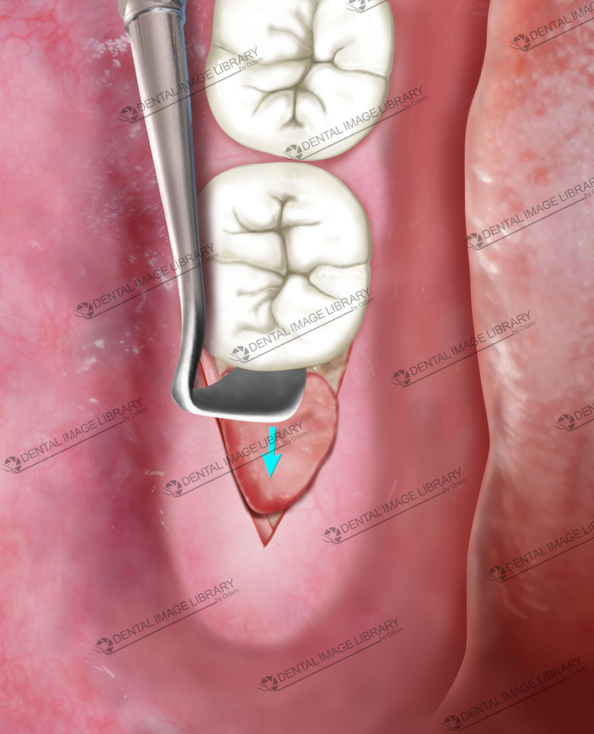 Distal wedge procedure. Collection of 4 illustrations | Dental Image ...