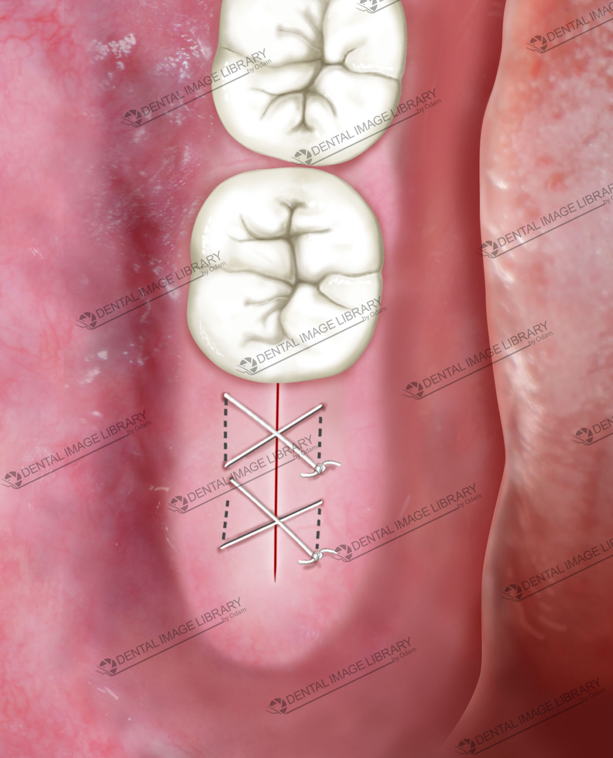 Distal wedge procedure. Collection of 4 illustrations | Dental Image ...