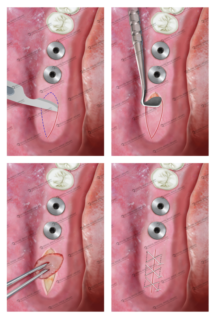 Distal wedge procedure - Implants. Collection of 4 illustrations ...